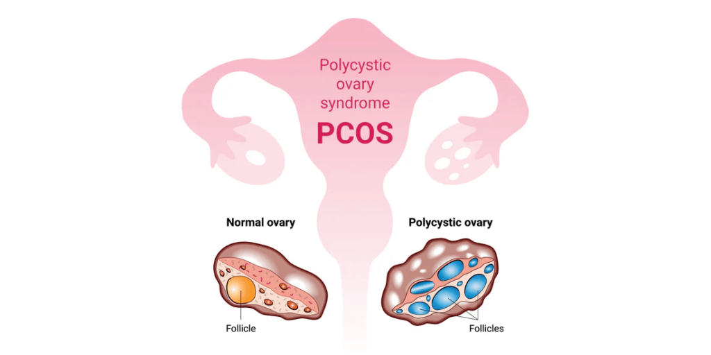 PCOS treatment in Bhopal by Gynecologist Dr. Nidhi Nagar
